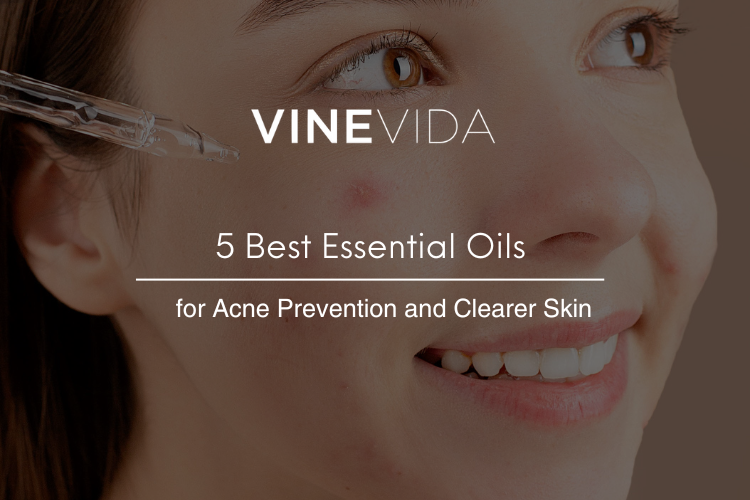 5 Best Essential Oils for Acne Prevention and Clearer Skin | VINEVIDA